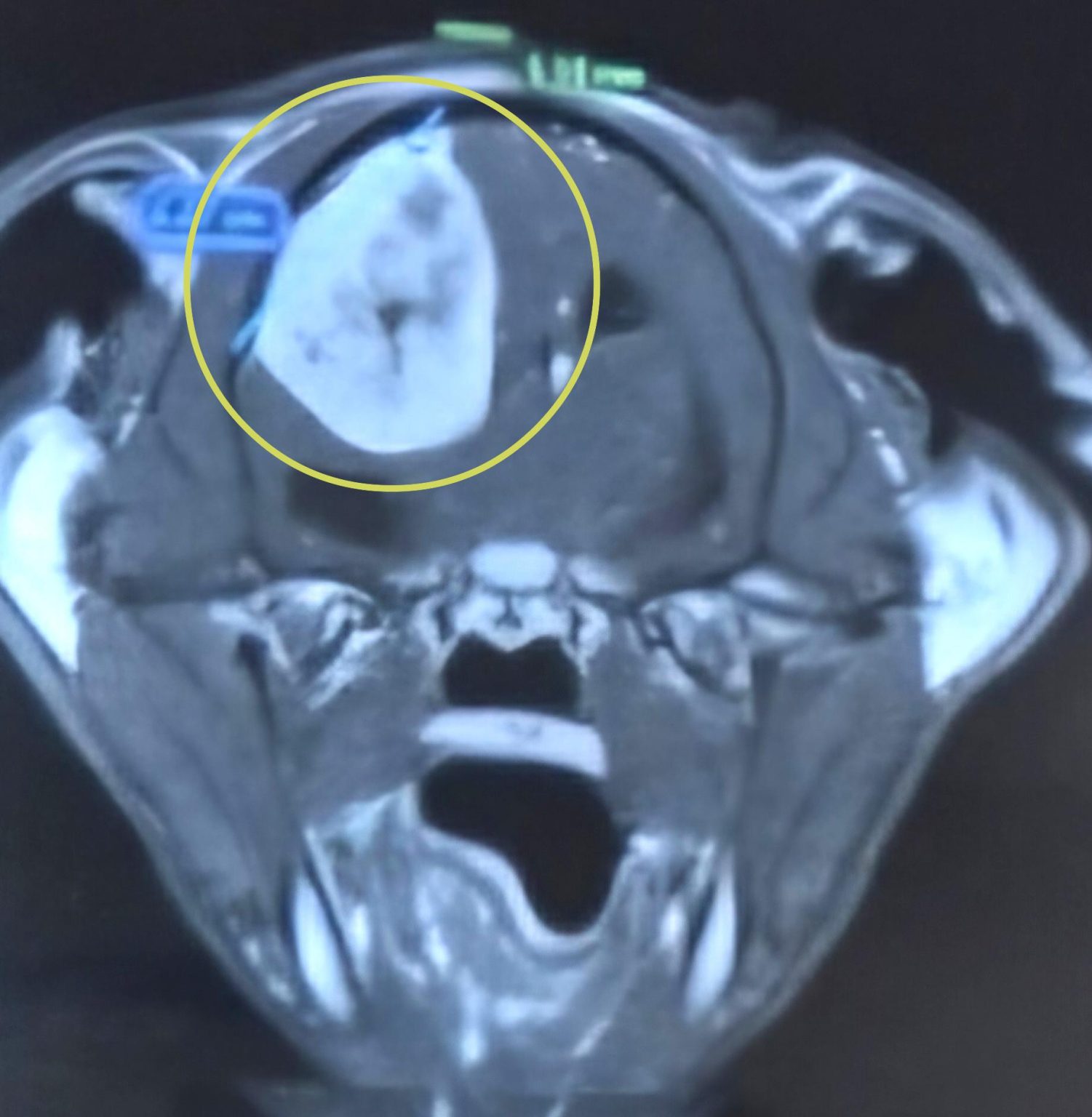 Another successful Craniectomy surgery performed by Bridge Referrals ...